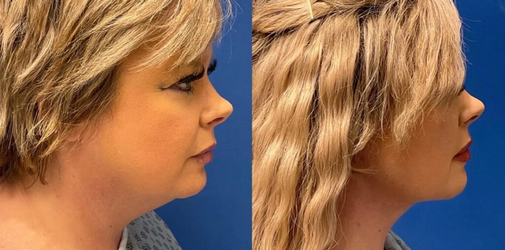 Facelift vs Renuvion Face - NuBody Concepts